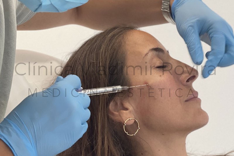 Tratamientos con Fillers | Clínica Vladimir Rovira en Barcelona